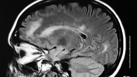 Neuralink của Elon Musk: ranh giới giữa khoa học và viễn tưởng